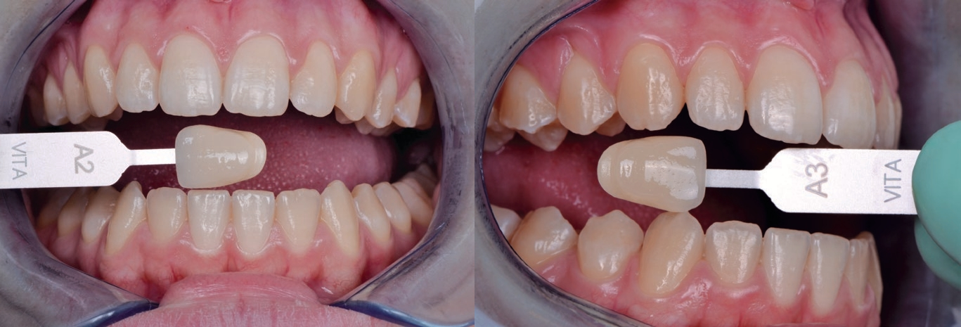 Maxillaris Clinical Case: Home Whitening, A2-B1 in 4 weeks